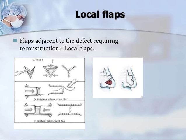 scope of Pedicled flaps in oral and maxillofacial surgery