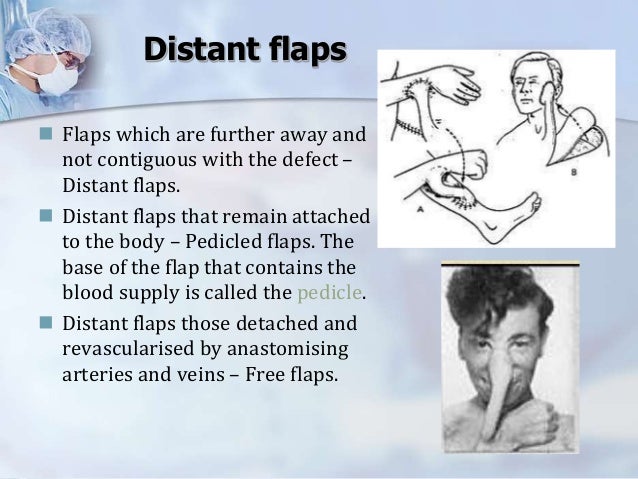 scope of Pedicled flaps in oral and maxillofacial surgery