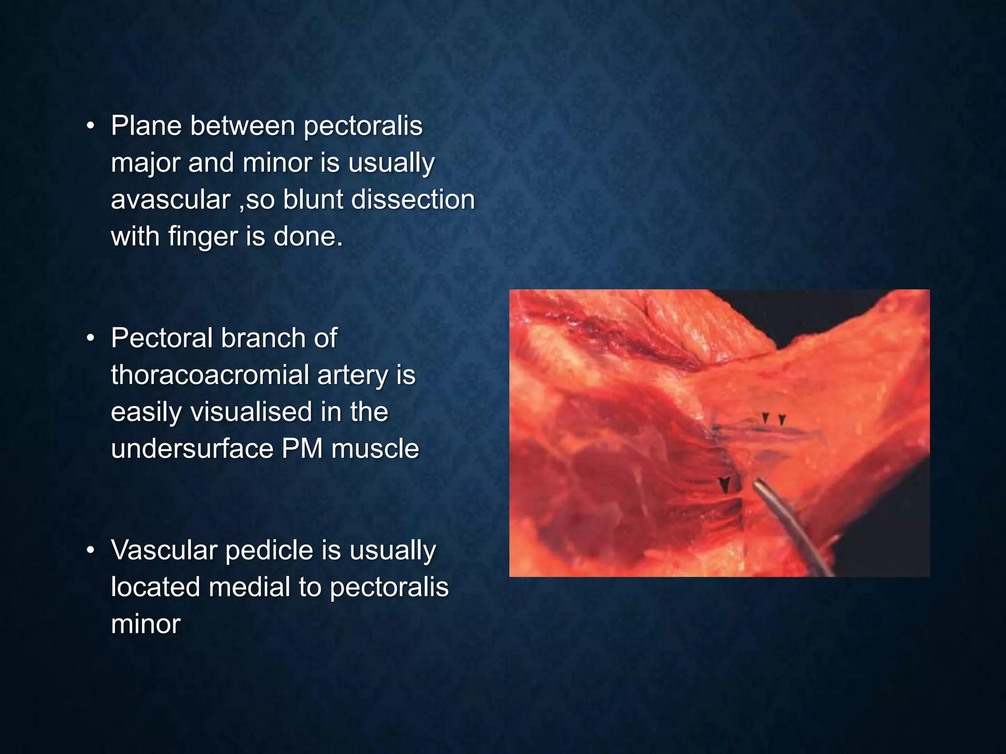 Pedicled flaps in head and neck surgery | PPTX