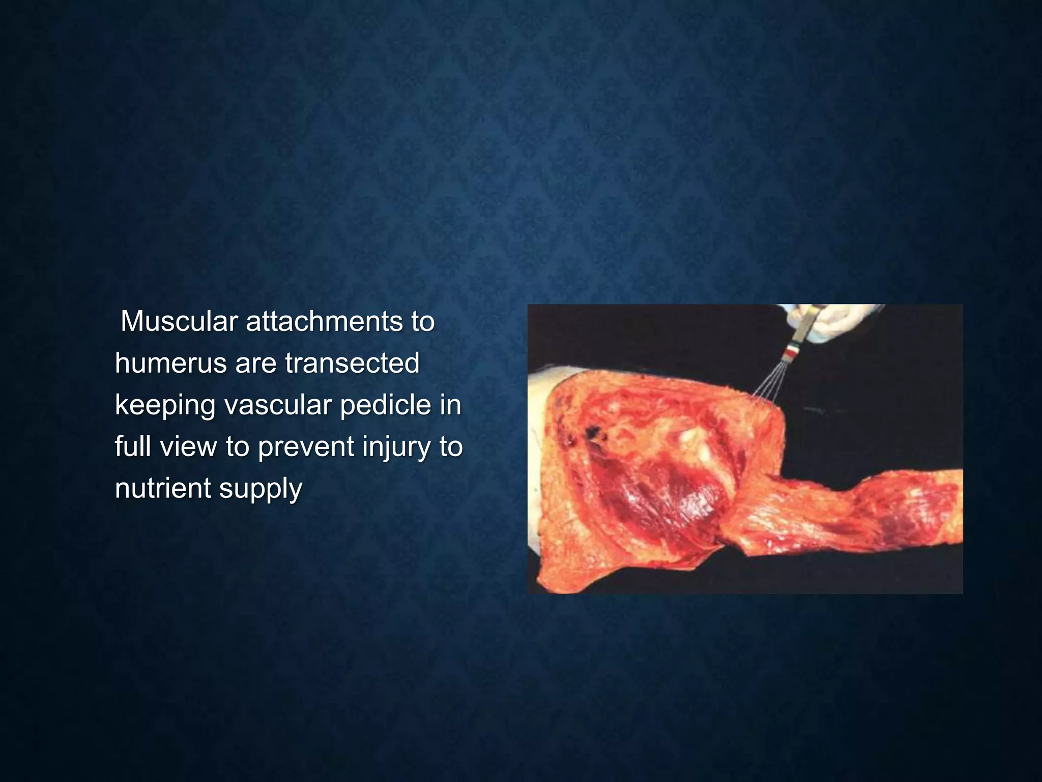 Pedicled flaps in head and neck surgery | PPTX