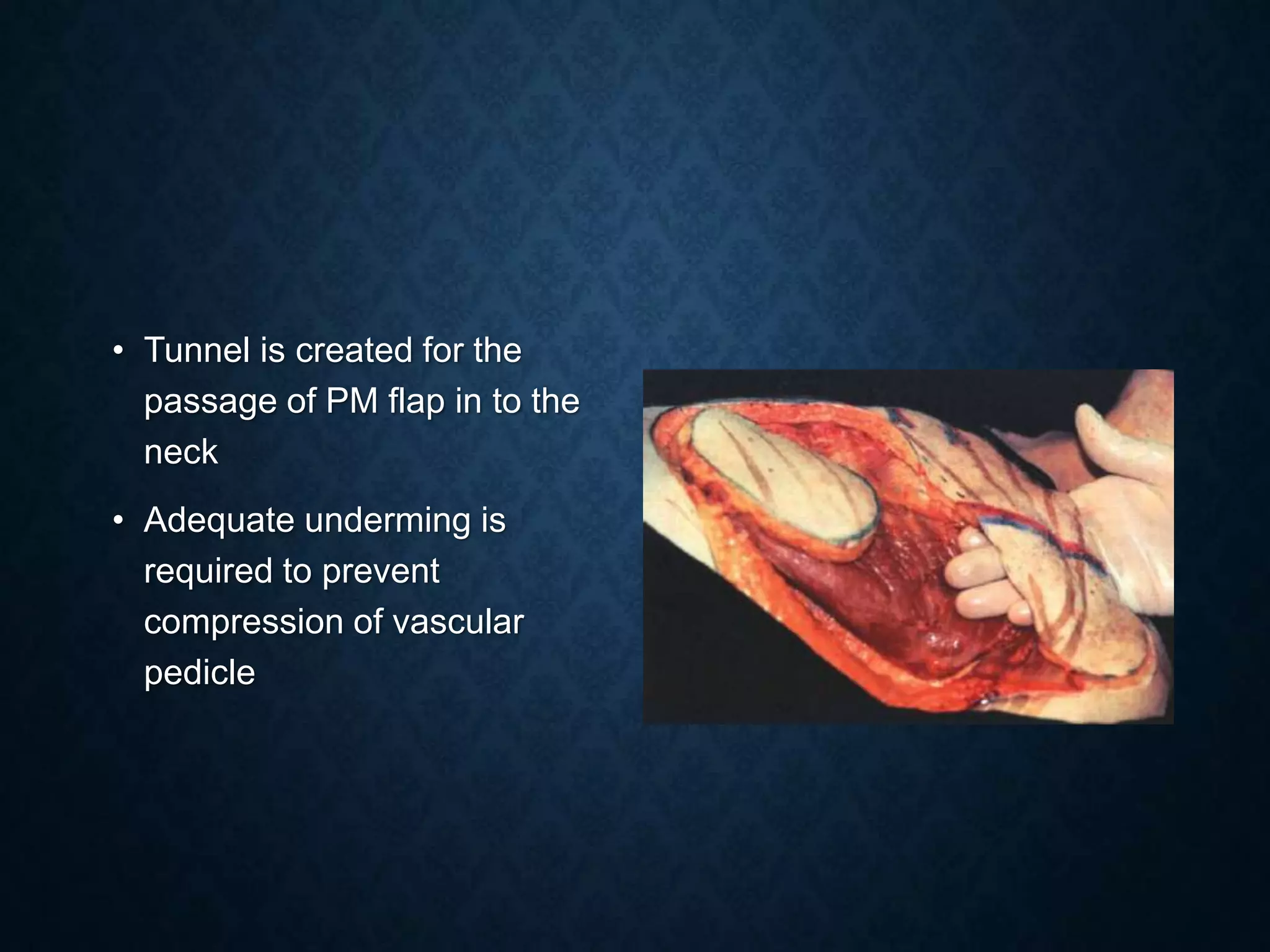Pedicled flaps in head and neck surgery | PPTX