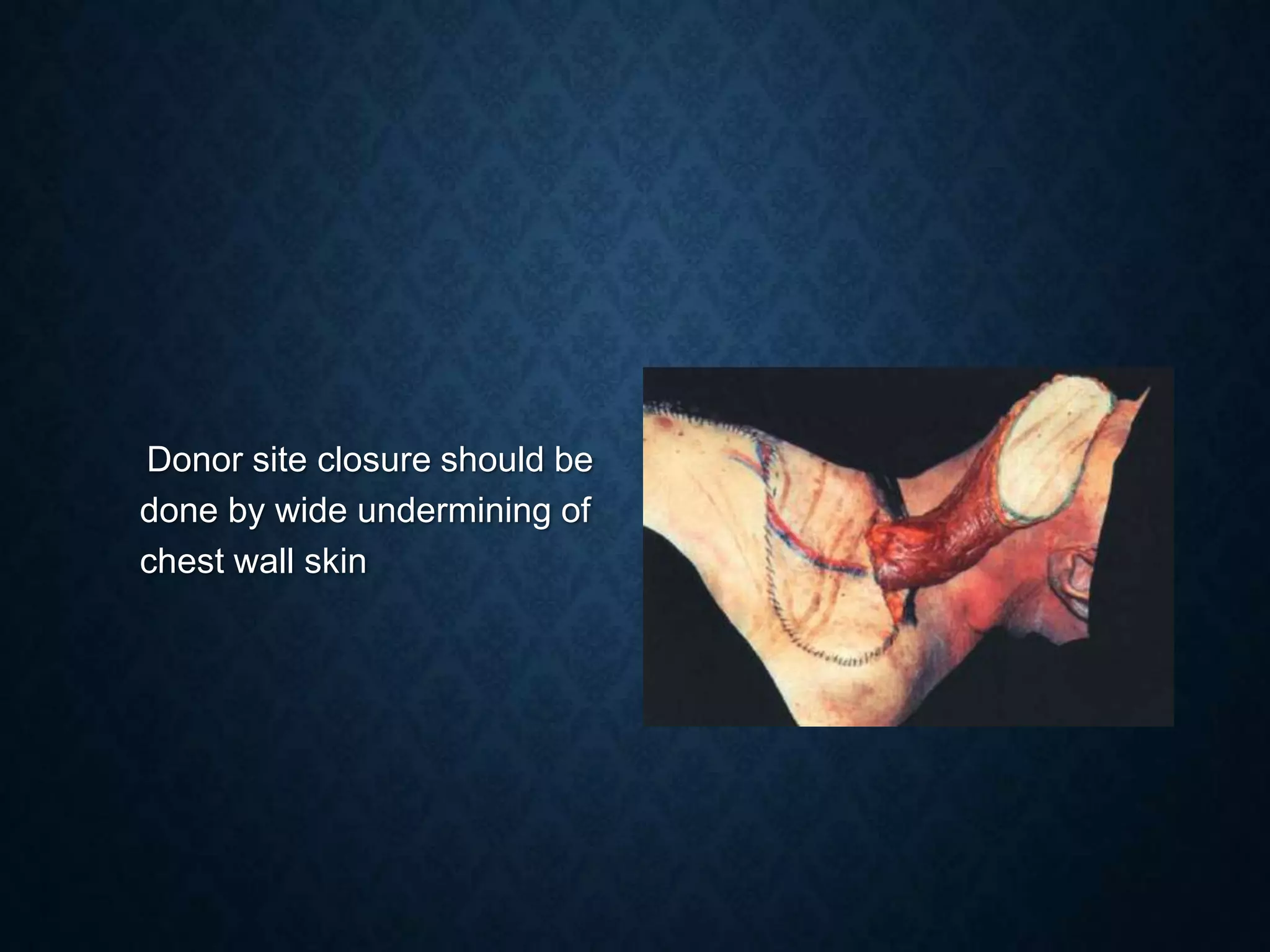 Pedicled flaps in head and neck surgery | PPTX