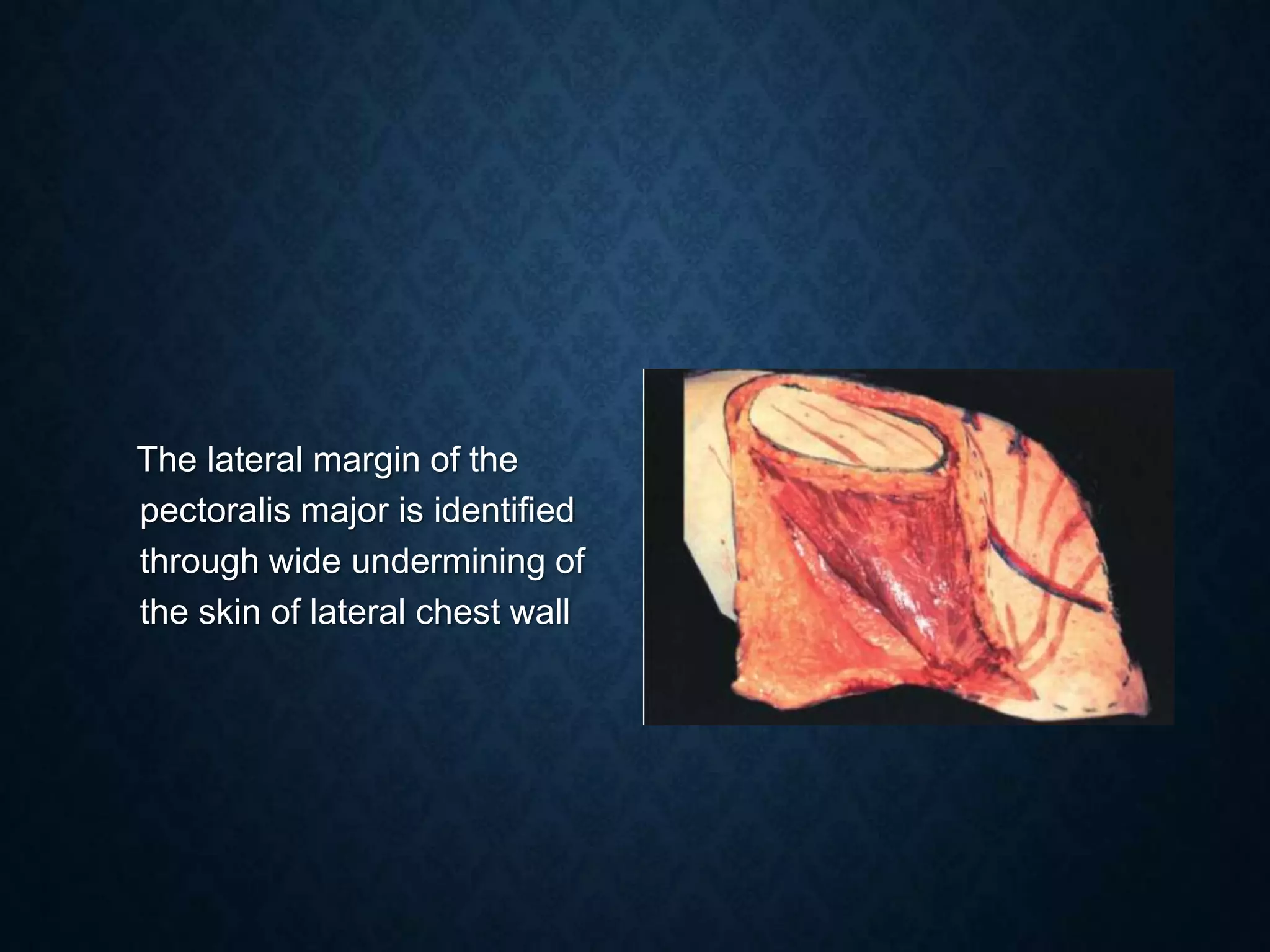 Pedicled flaps in head and neck surgery | PPTX