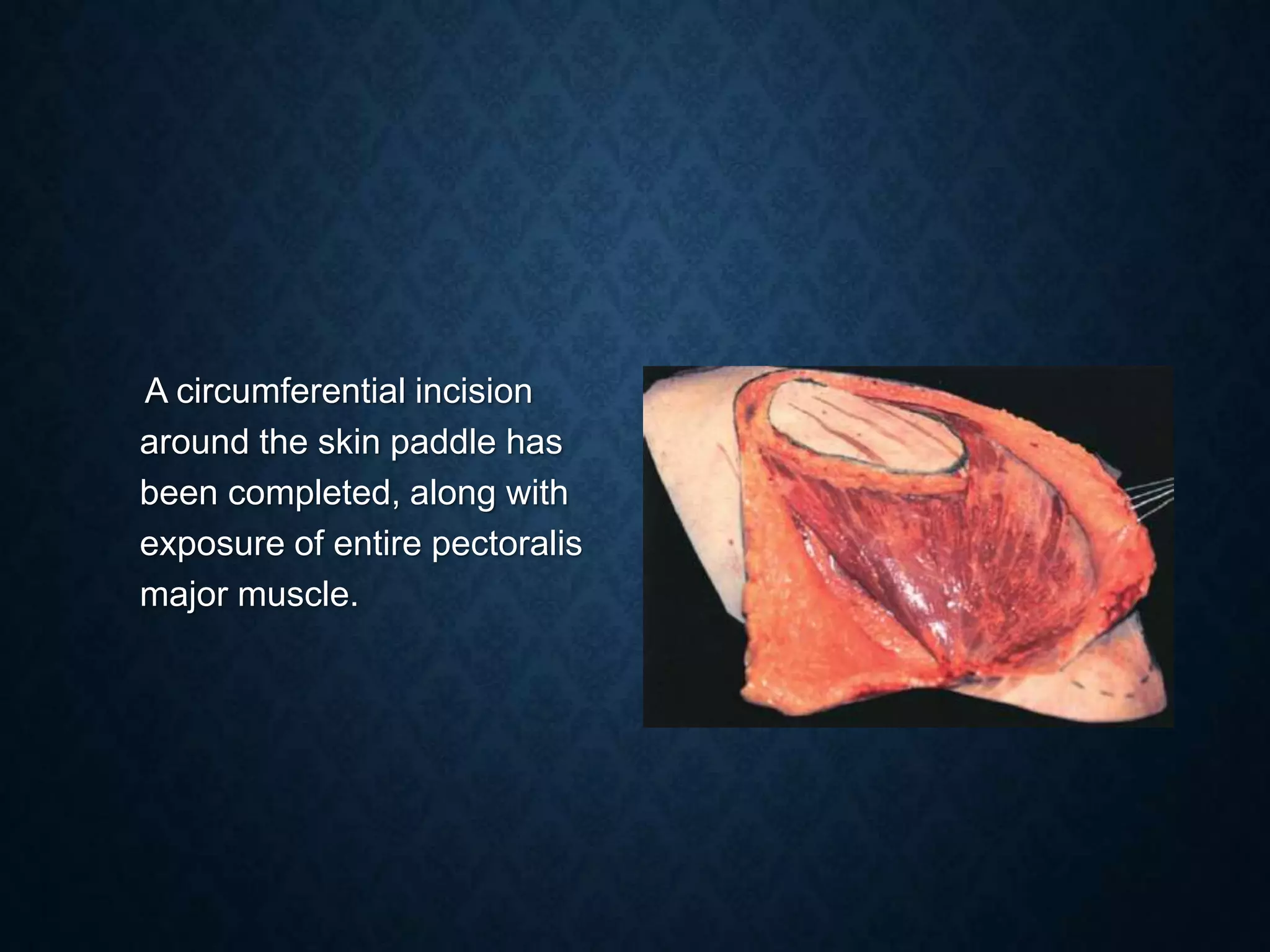 Pedicled flaps in head and neck surgery | PPTX