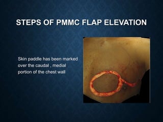 Pedicled flaps in head and neck surgery | PPTX