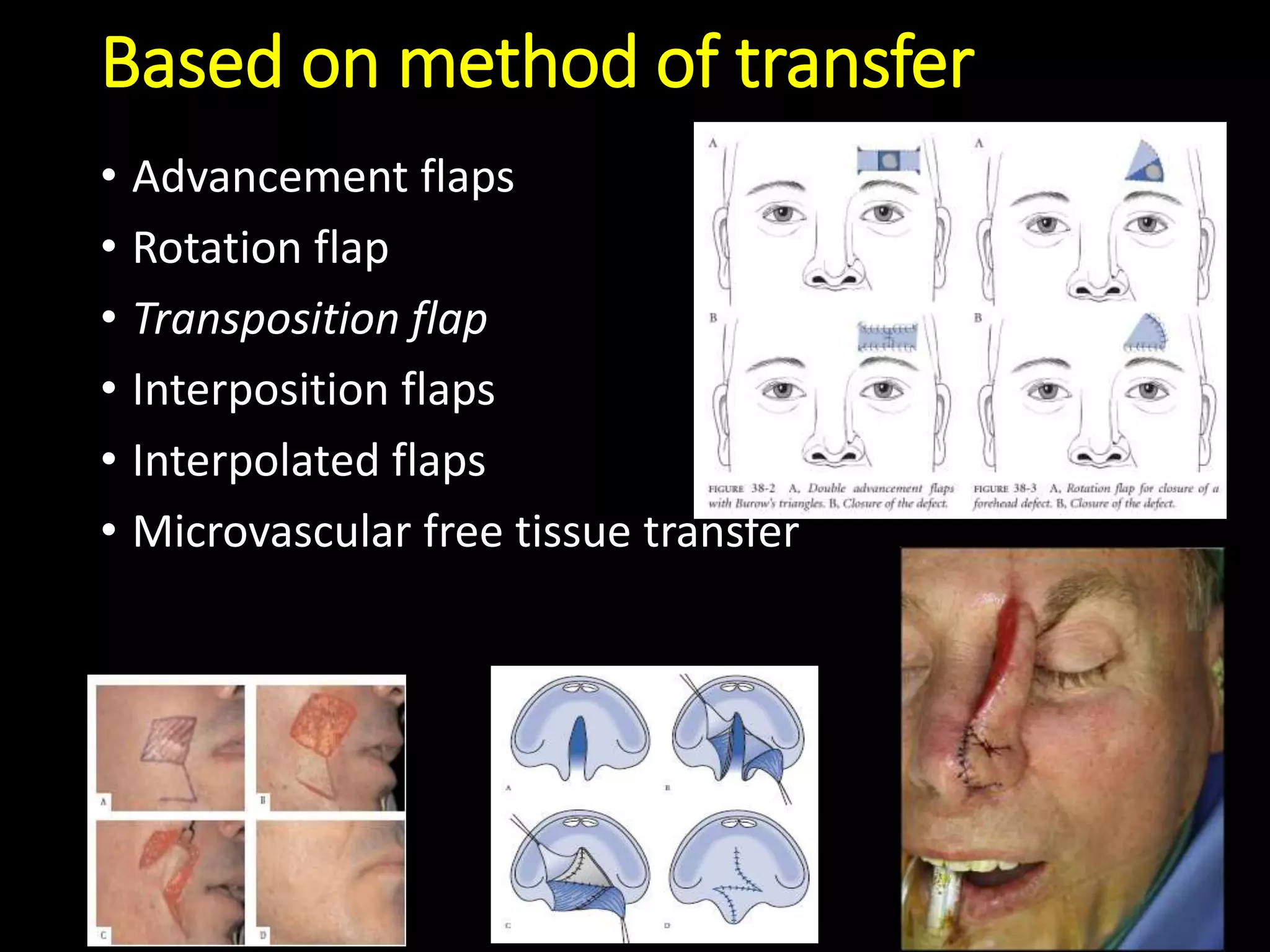 Pedicle flap in Maxillofacial Surgery | PPTX