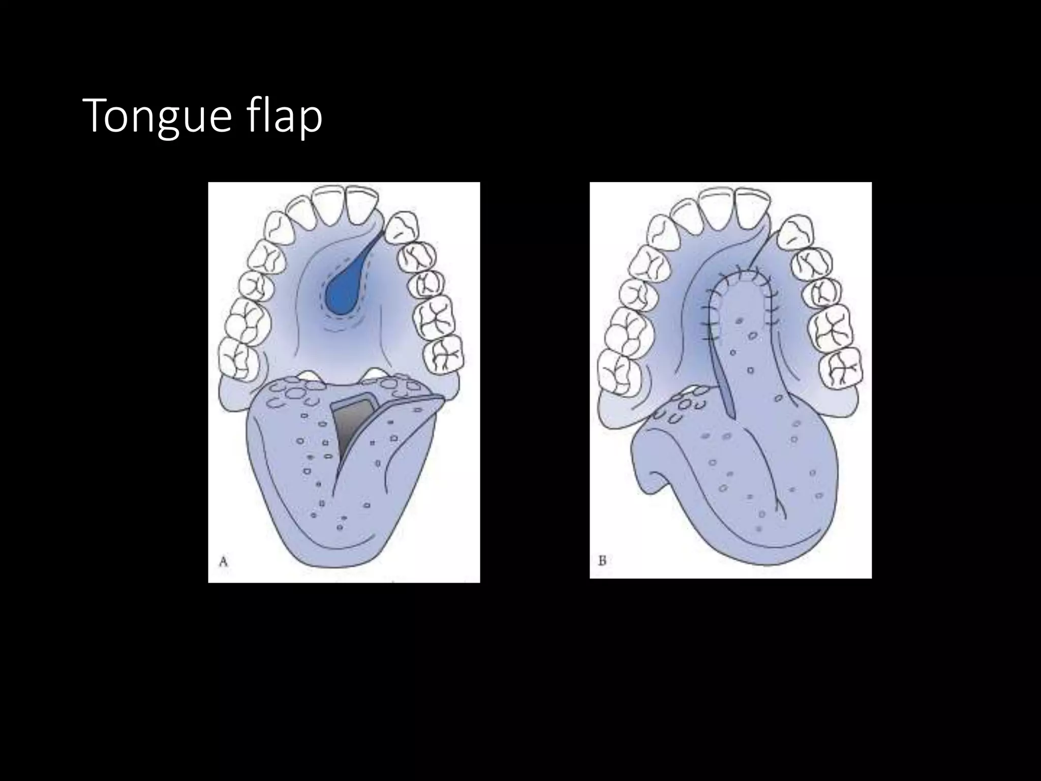 Pedicle flap in Maxillofacial Surgery | PPTX