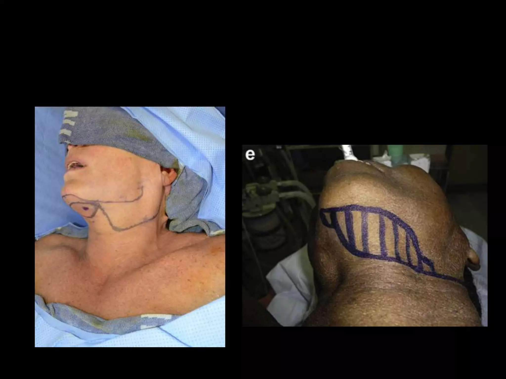 Pedicle flap in Maxillofacial Surgery | PPTX
