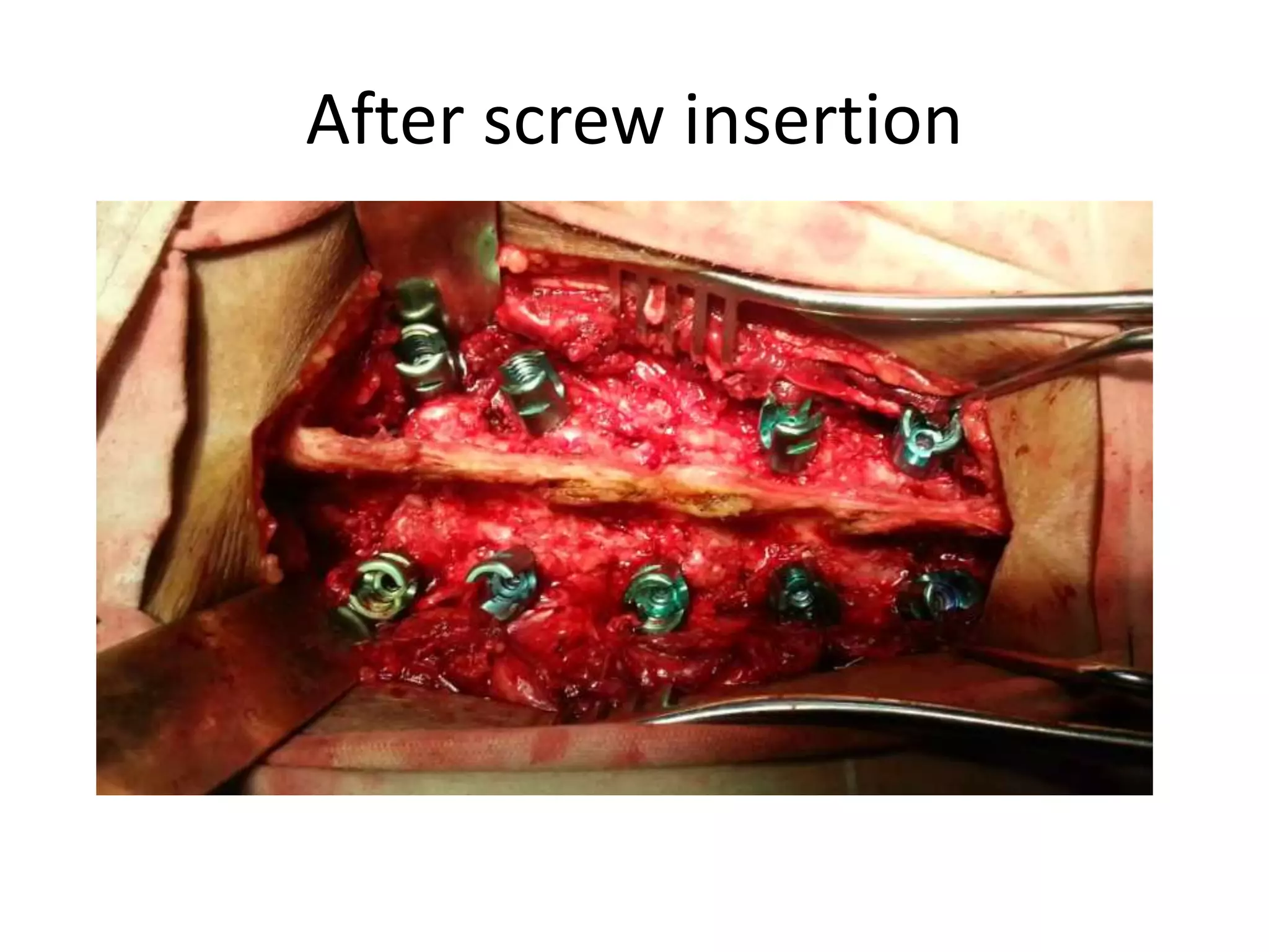 Pedicle screw by professor shah alam | PPTX