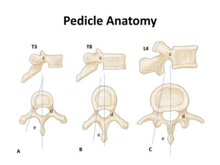 Pedicle screw by professor shah alam | PPTX