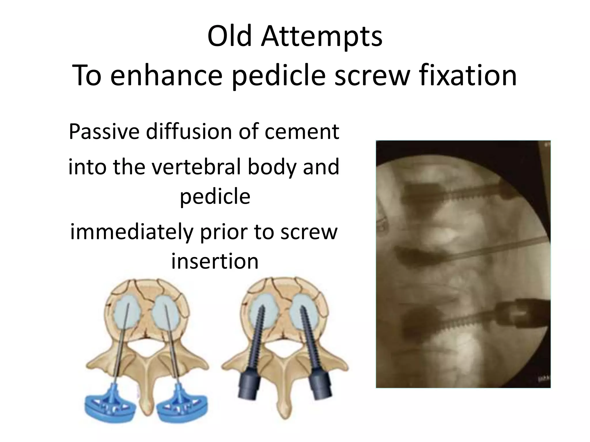 Pedicle screw fixation in osteoporotic fractures | PPTX