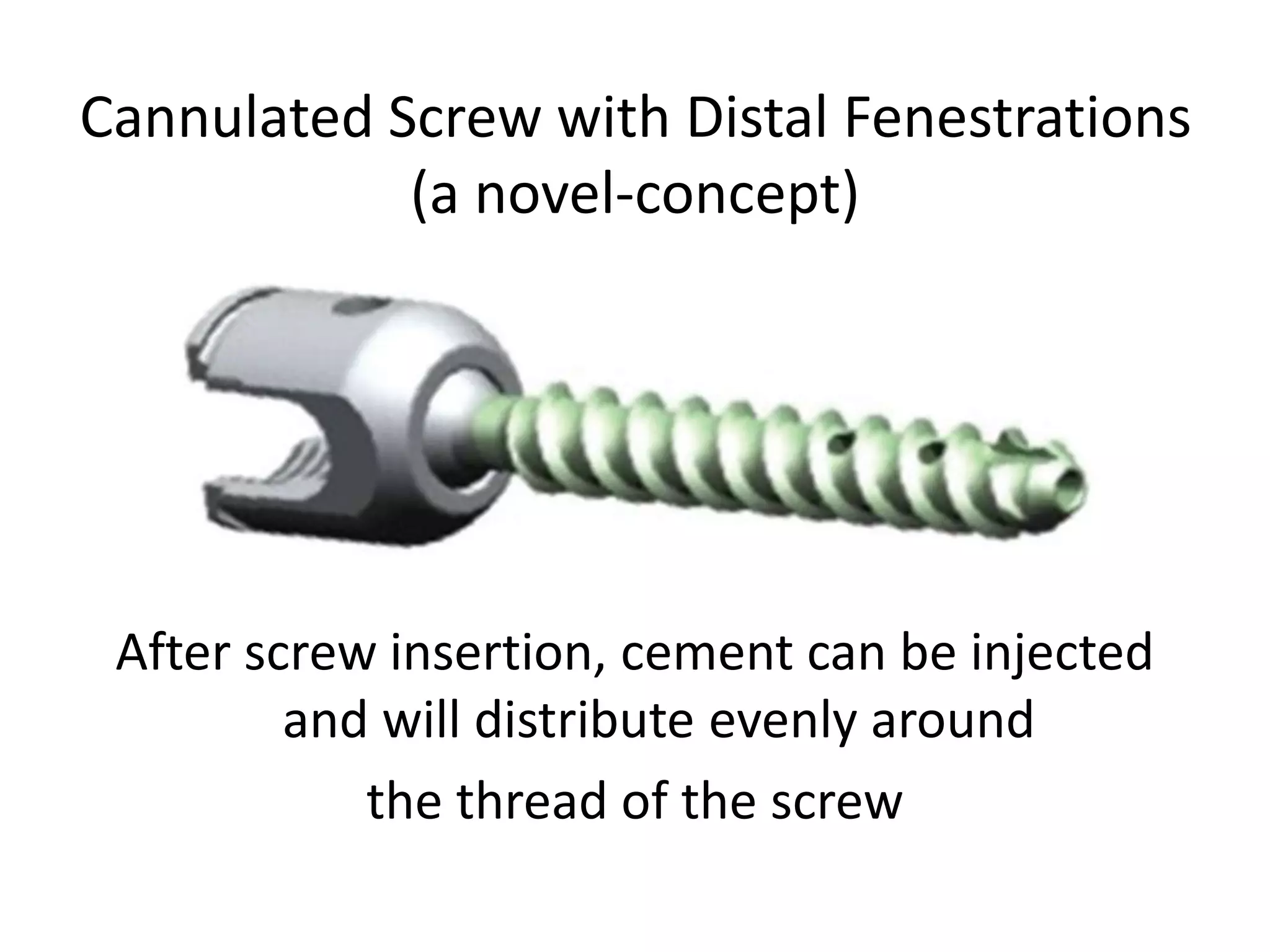 Pedicle screw fixation in osteoporotic fractures | PPTX