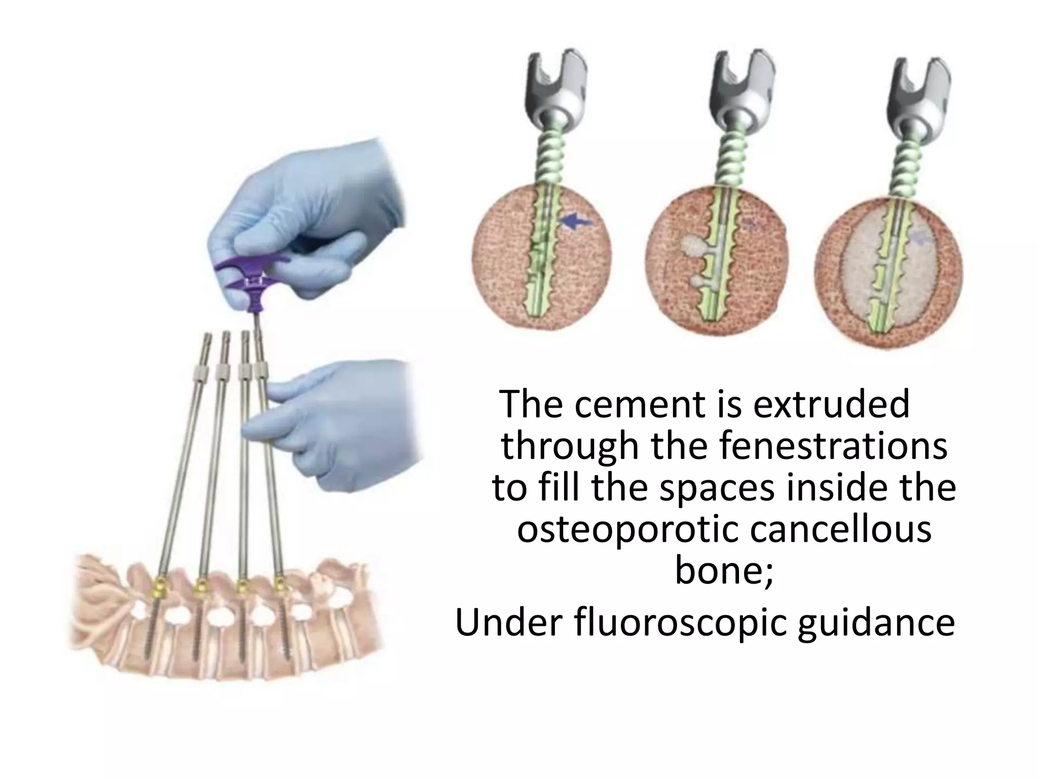 Pedicle screw fixation in osteoporotic fractures | PPTX