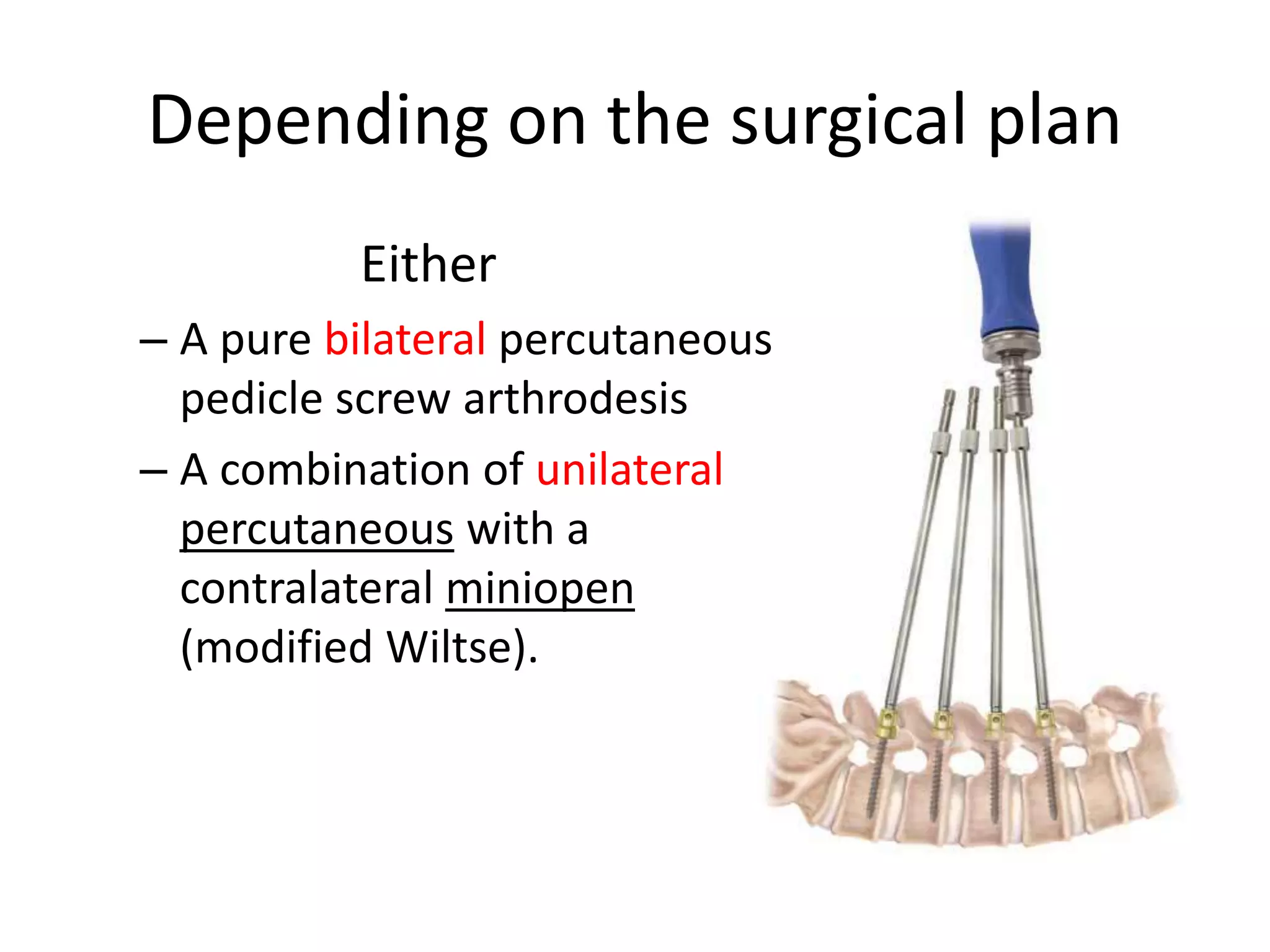 Pedicle screw fixation in osteoporotic fractures | PPTX