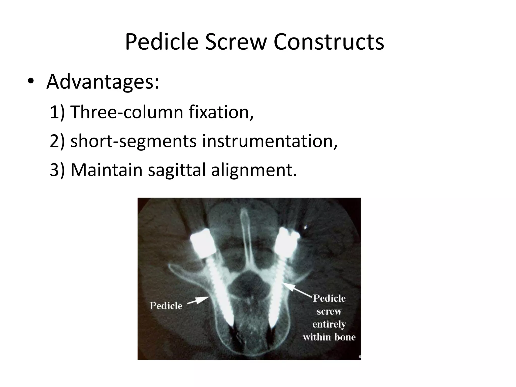 Pedicle screw fixation in osteoporotic fractures | PPTX