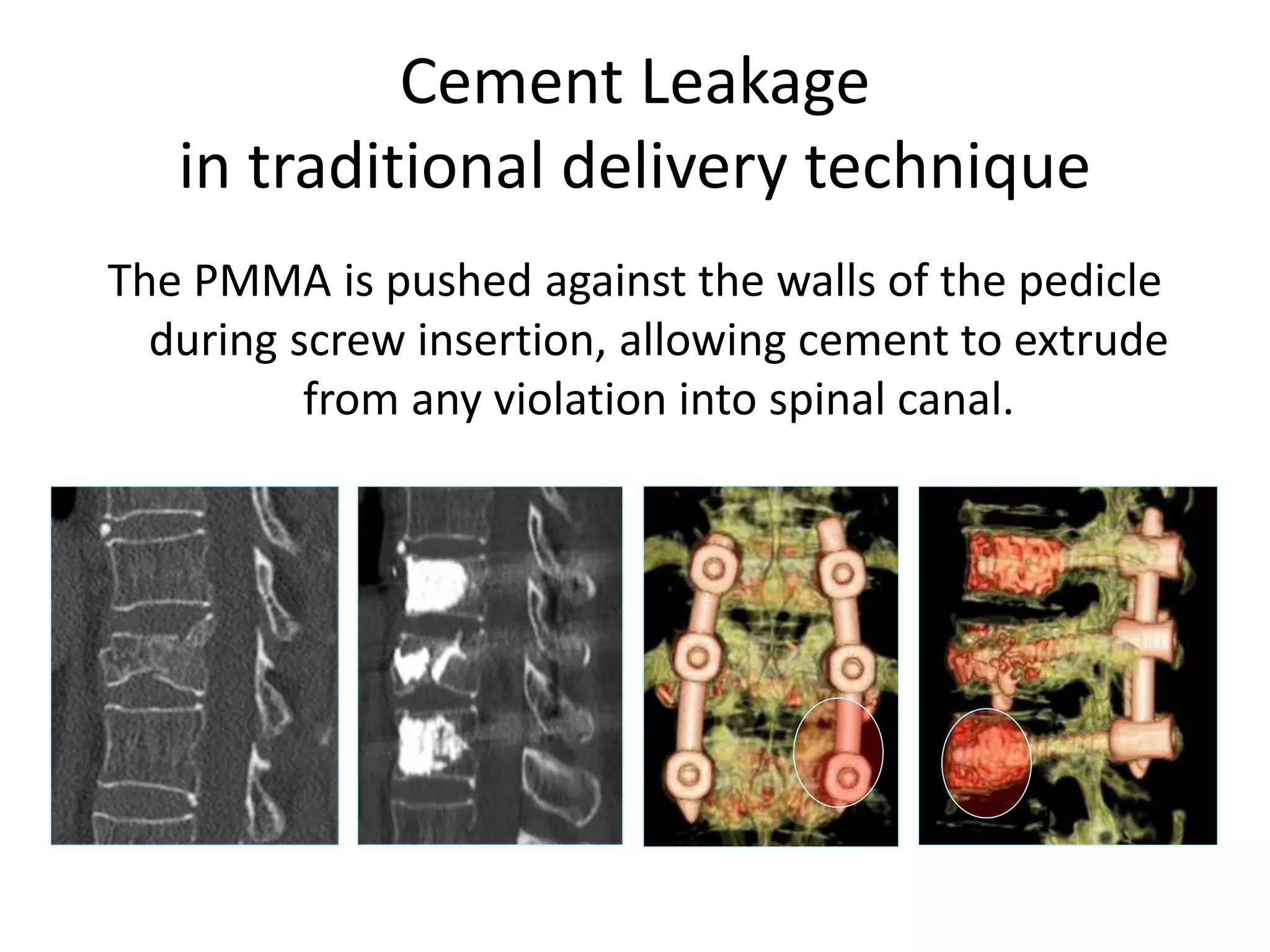 Pedicle screw fixation in osteoporotic fractures | PPTX