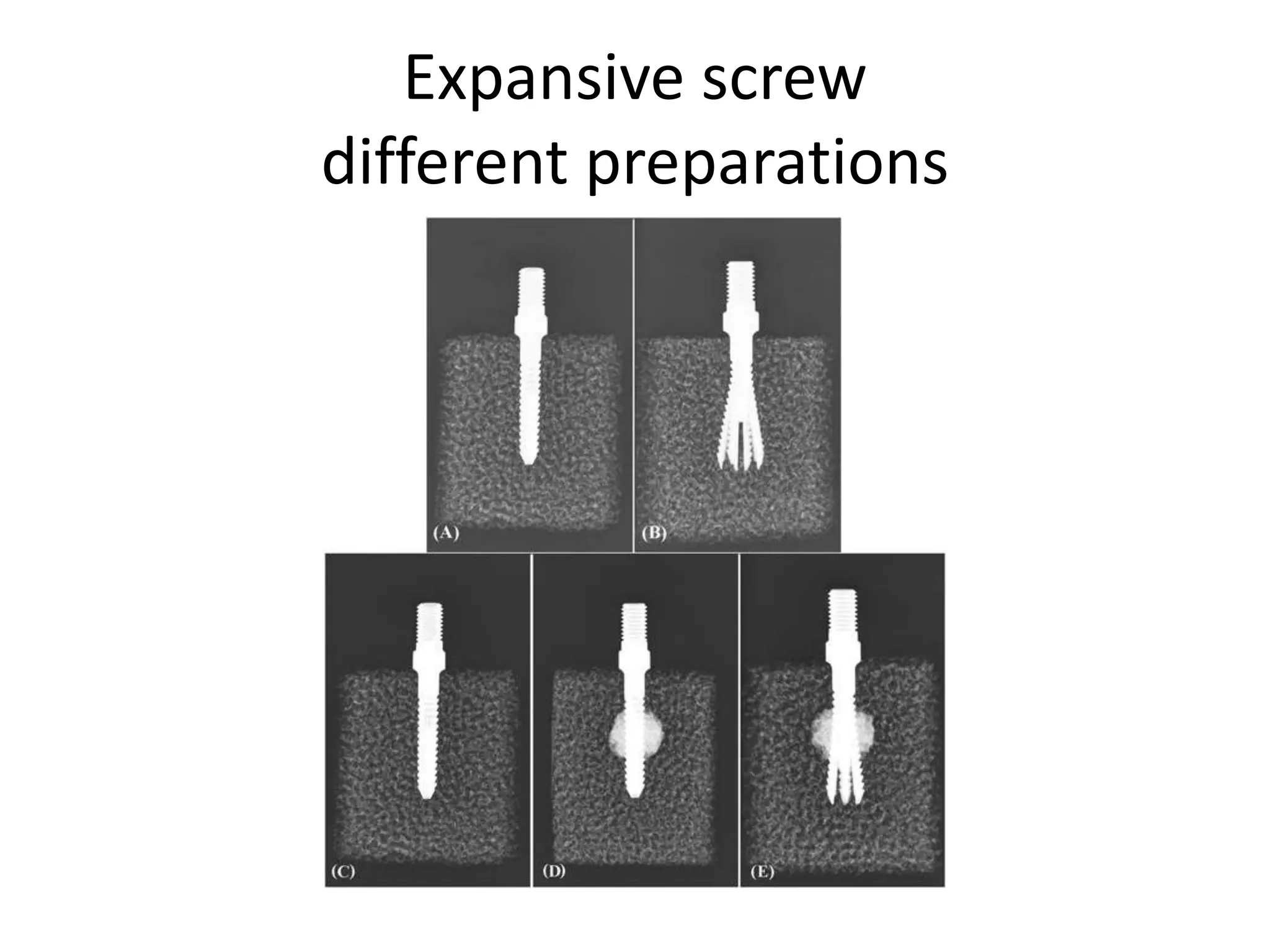 Pedicle screw fixation in osteoporotic fractures | PPTX