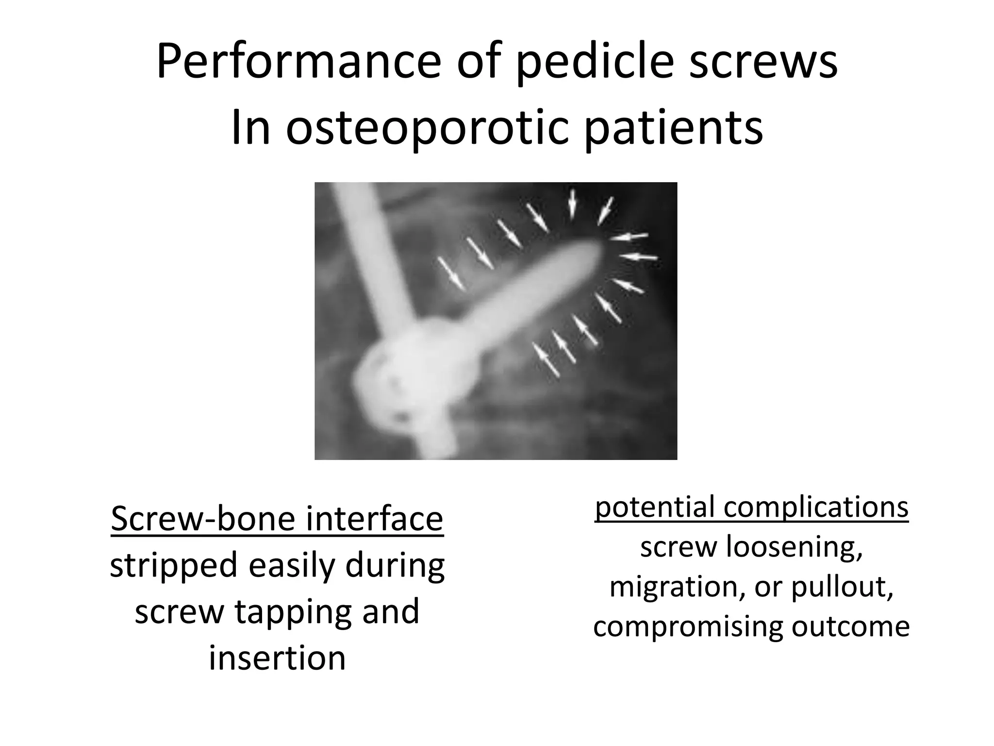 Pedicle screw fixation in osteoporotic fractures | PPTX