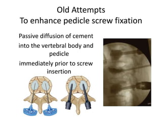 Pedicle screw fixation in osteoporotic fractures | PPTX