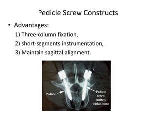 Pedicle screw fixation in osteoporotic fractures | PPTX