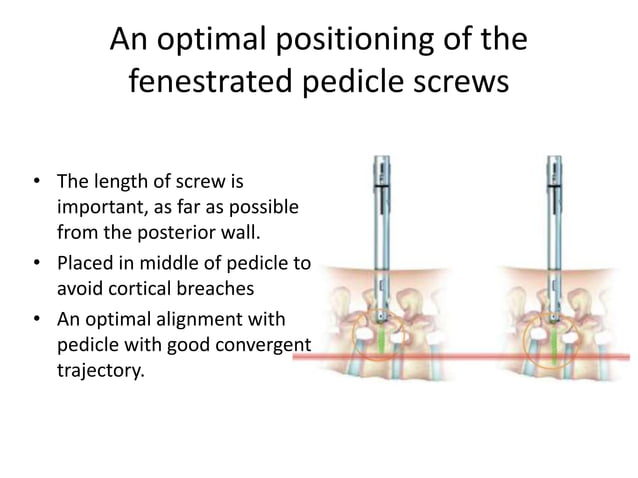 Pedicle screw fixation in osteoporotic fractures | PPT