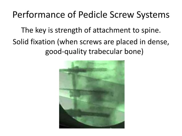 Pedicle screw fixation in osteoporotic fractures | PPT