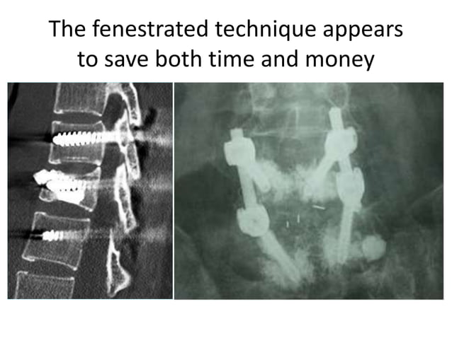 Pedicle screw fixation in osteoporotic fractures | PPT