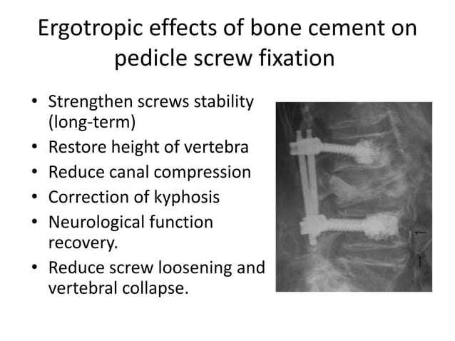 Pedicle screw fixation in osteoporotic fractures | PPT