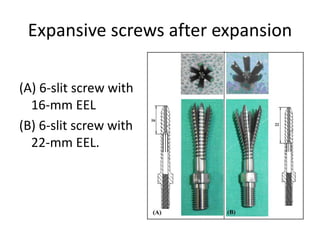 Pedicle screw fixation in osteoporotic fractures | PPTX