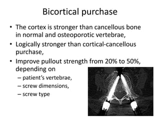 Pedicle screw fixation in osteoporotic fractures | PPTX