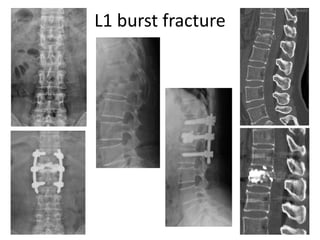 Pedicle screw fixation in osteoporotic fractures | PPTX