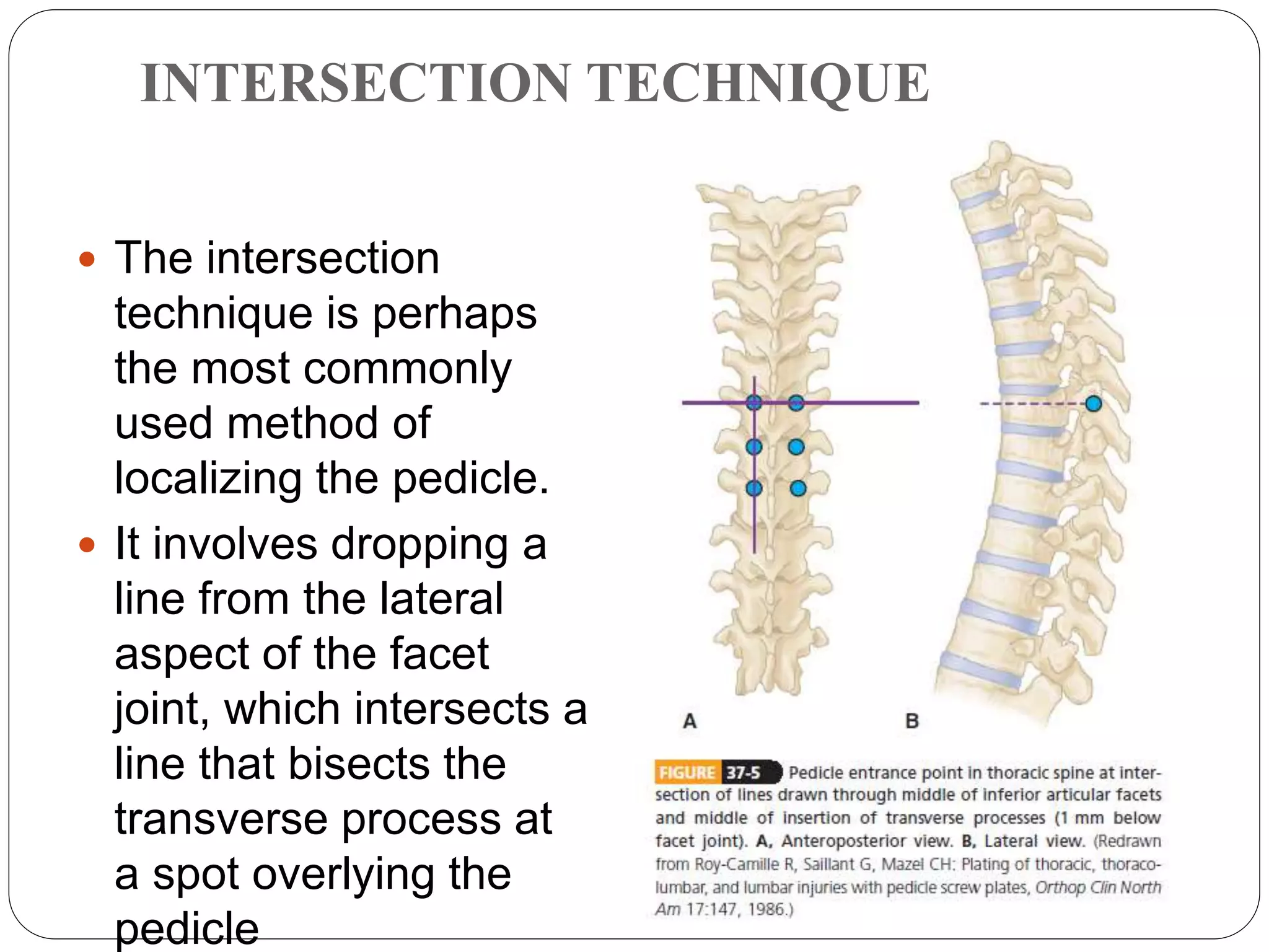 Pedicle Screws Fixation of Thoraco-Lumbar Spine | PPTX