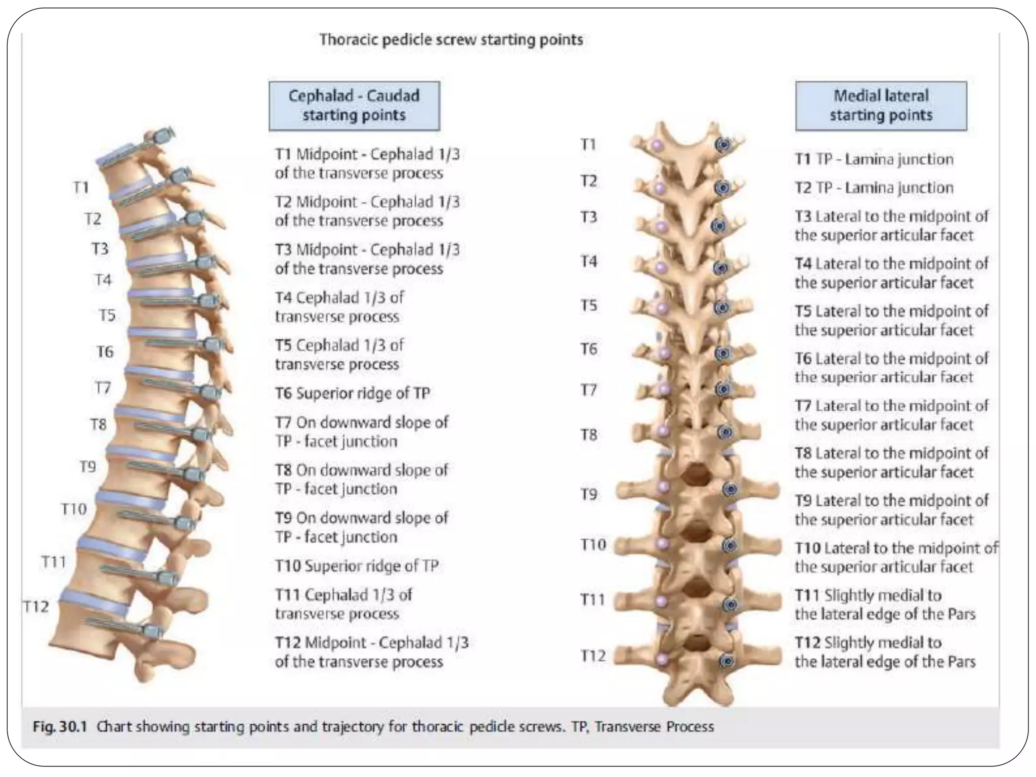 Pedicle Screws Fixation of Thoraco-Lumbar Spine | PPTX