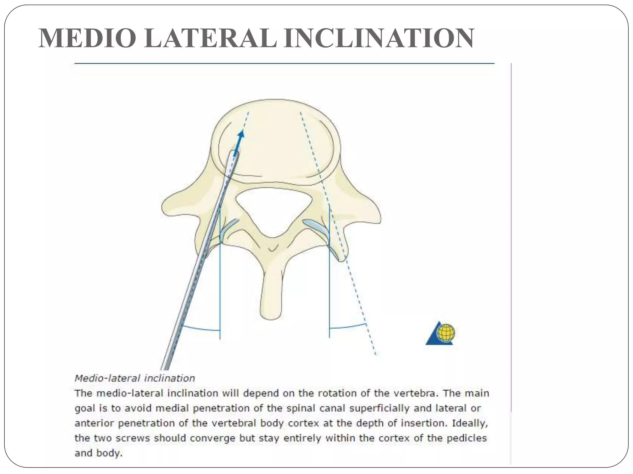 Pedicle Screws Fixation of Thoraco-Lumbar Spine | PPTX