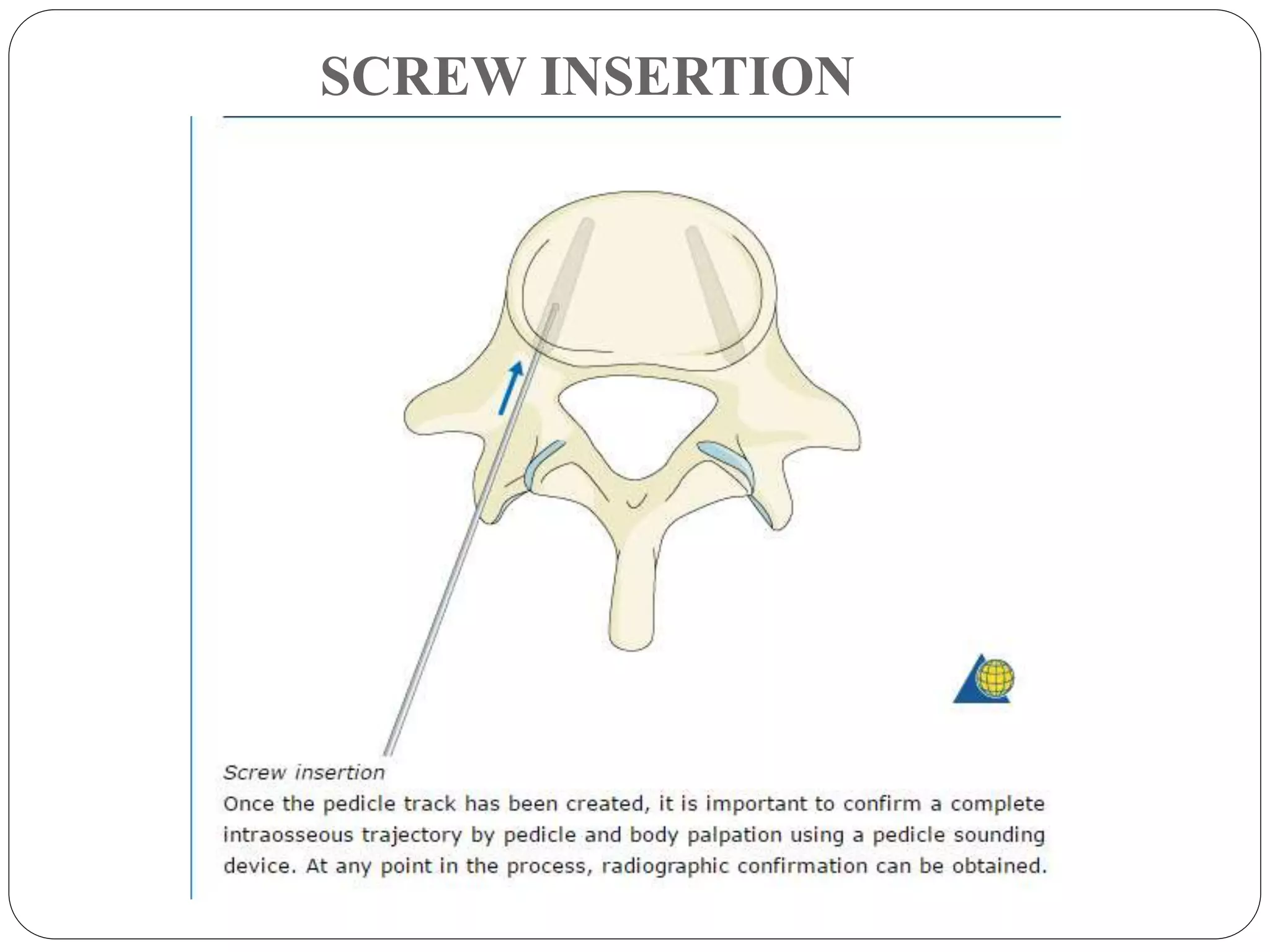 Pedicle Screws Fixation of Thoraco-Lumbar Spine | PPTX