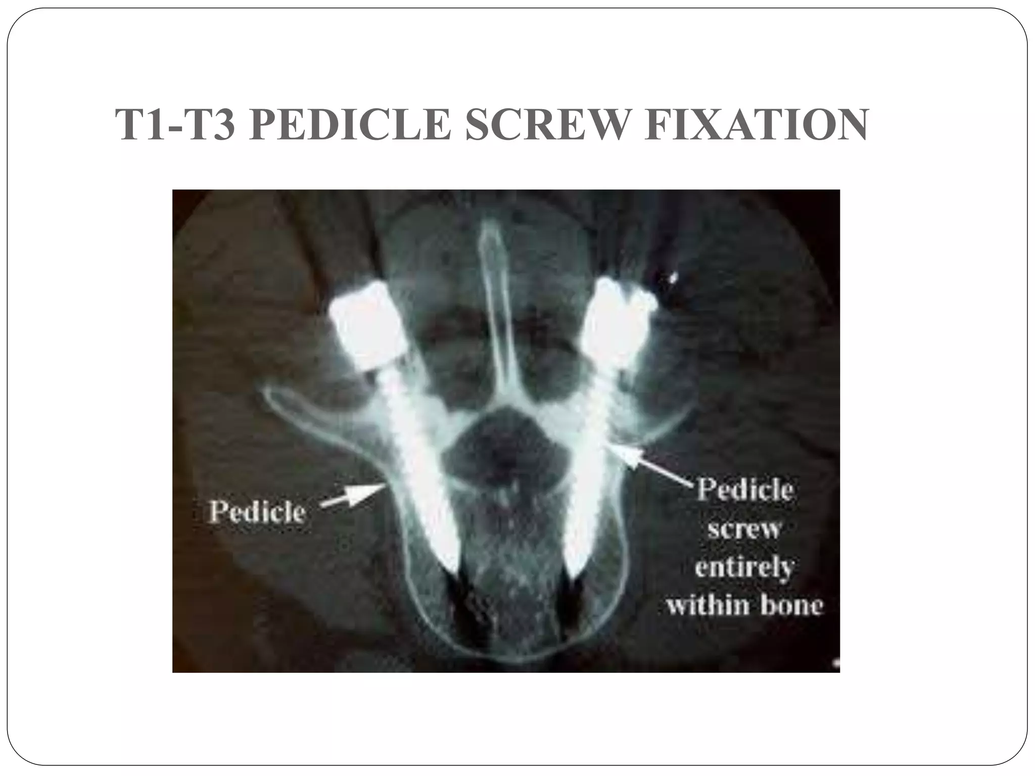 Pedicle Screws Fixation of Thoraco-Lumbar Spine | PPTX