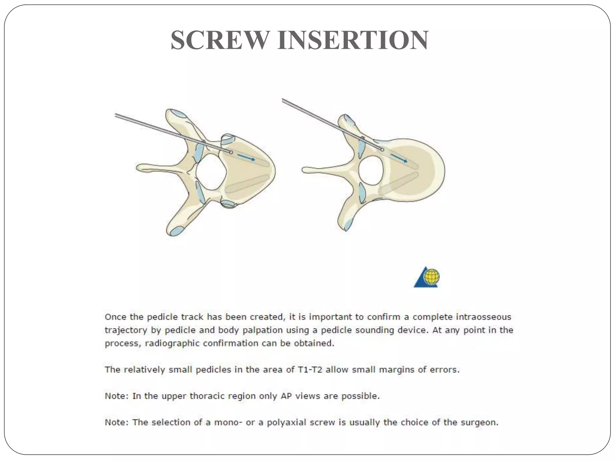 Pedicle Screws Fixation of Thoraco-Lumbar Spine | PPTX