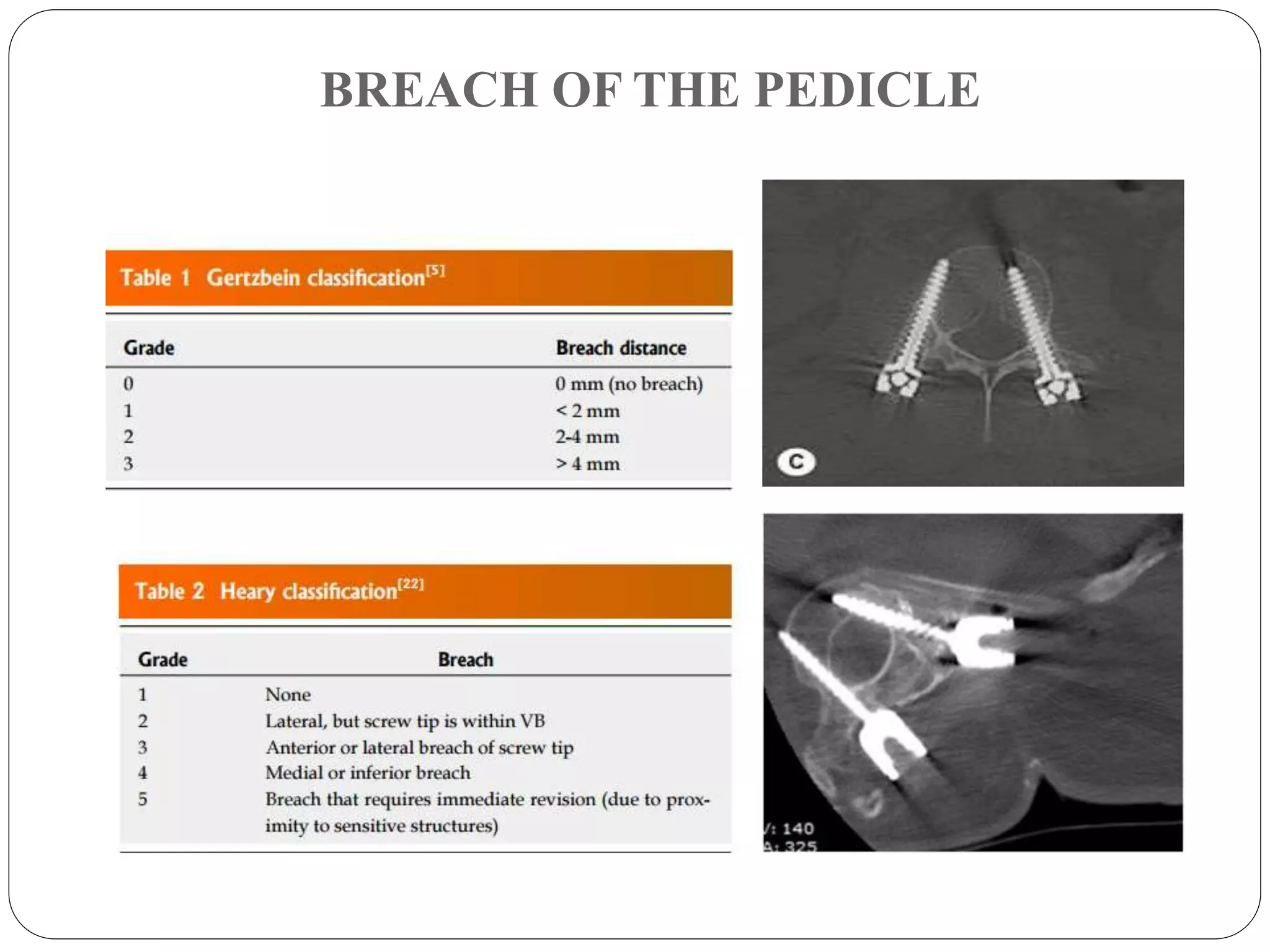 Pedicle Screws Fixation of Thoraco-Lumbar Spine | PPTX