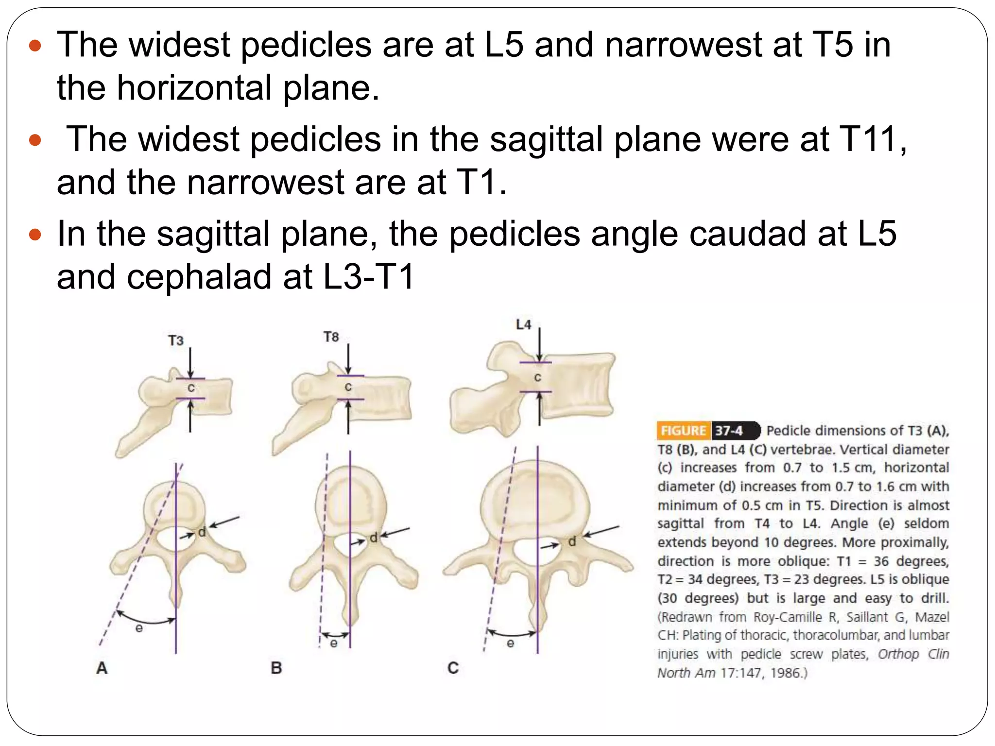Pedicle Screws Fixation of Thoraco-Lumbar Spine | PPTX