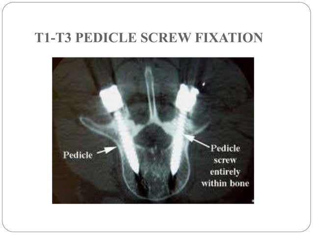 Pedicle Screws Fixation of Thoraco-Lumbar Spine | PPTX | Death, Injury ...