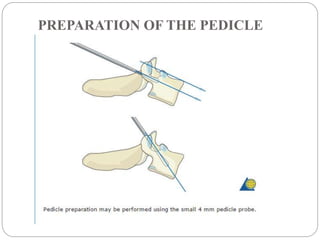 Pedicle Screws Fixation of Thoraco-Lumbar Spine | PPTX