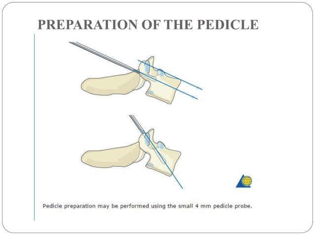 Pedicle Screws Fixation of Thoraco-Lumbar Spine | PPTX | Death, Injury ...