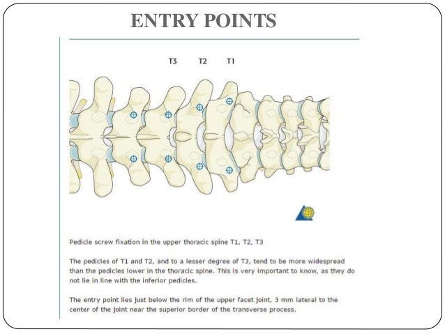 Pedicle Screws Fixation of Thoraco-Lumbar Spine