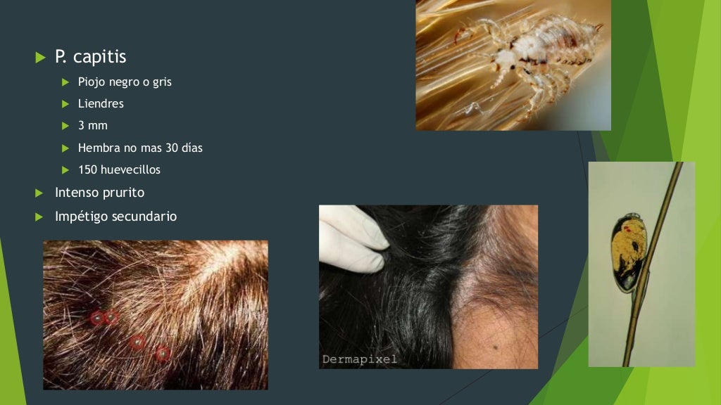 Pediculosis pediculosis