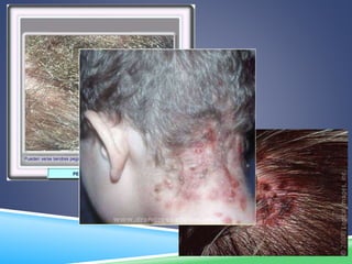 Pediculosis - Pediculosis capitis, corporis y púbica | PPTX