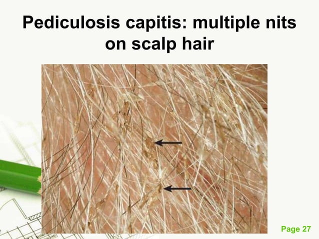 Pediculosis | PPT | Infectious Diseases | Diseases and Conditions
