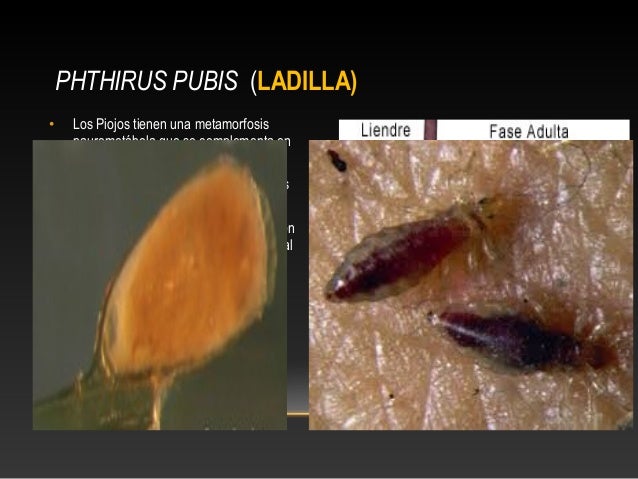 Pediculosis púbica (Phthirus pubis-Ladillas)
