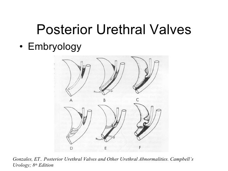 Posterior Urethral Valve Upstate Golisano Children39s
