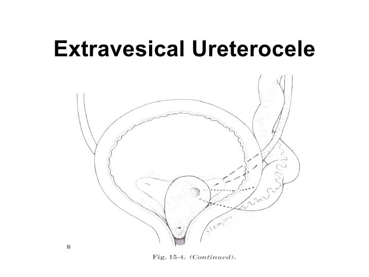 Pedi gu review ureteral anomalies i