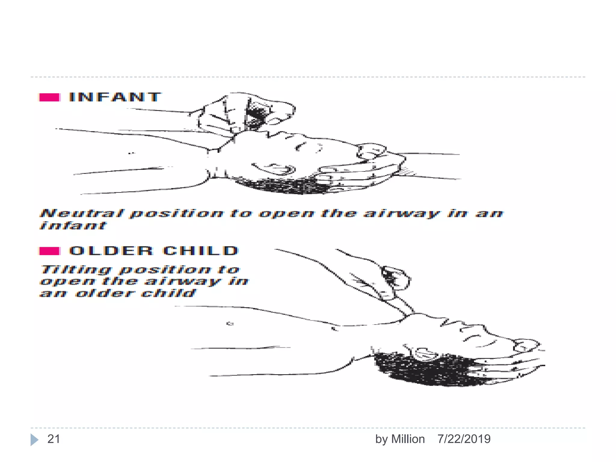 pediatric air way obstruction | PPTX